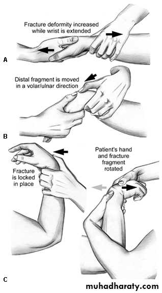 Colles Fracture Pptx د احمد لطيف Muhadharaty
